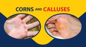All about Corn & Calluses - Total Skin Pro Clinic