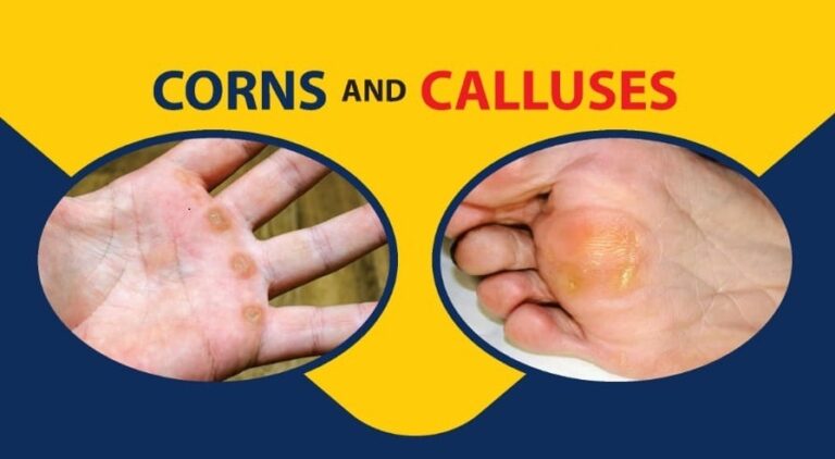All about Corn & Calluses - Total Skin Pro Clinic