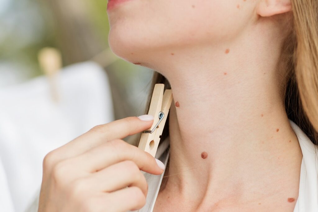 Skin tags- Don’t let them hang on your skin, Get rid of them – Total ...